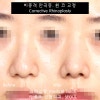 심하게 휜 코 수술 비중격 만곡증 교정 코 절골 후기 【dr 아베크 코성형】 네이버 블로그